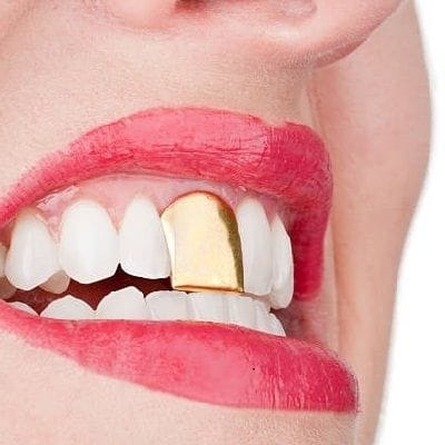 Gold Teeth in Dubai & Abu Dhabi | Dynamic Life Clinics