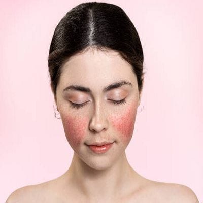 Understanding the 4 Types and Rosacea Treatment Options